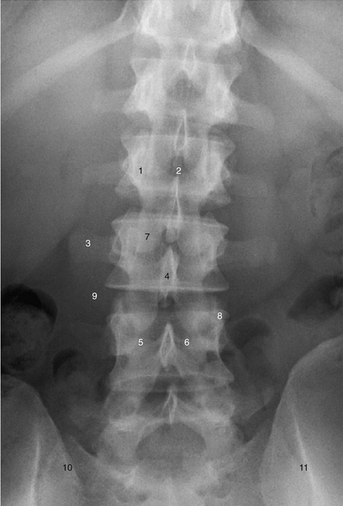 [요추]★[X-ray] L-spine X-ray : 네이버 블로그