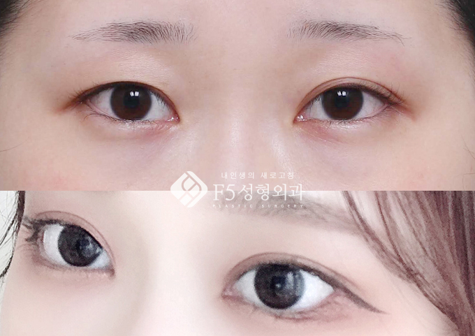 이마로 눈뜨는 비대칭눈짝눈 교정 될 수 있을까요 아웃라인 절개쌍수 눈매교정 실제 수술 전 후 사례 네이버 블로그