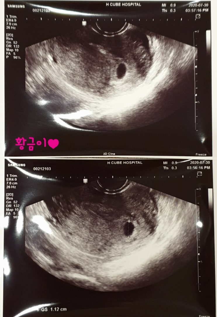 초음파사진 4w3dand4주and4주차5w3dand5주and5주차 에이치큐브산부인과노원구보건소초음파사진임신초기0주~12주