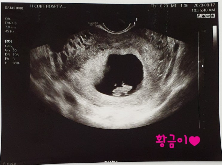 초음파사진 8w0dand8주and8주차 에이치큐브산부인과첫심장소리첫심장소리듣기초음파사진임신초기0주~12주둘째