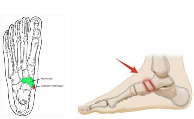 [재활운동] 부주상골 증후군(Accessory navicular bone syndrome : 네이버 블로그