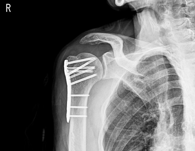 (세민에스요양병원)우측 상완골 골절 후 고정술 환자 (ORIF:open reduction and internal fixation ...