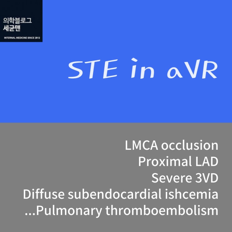 [심전도] STE in aVR...DDx : 네이버 블로그