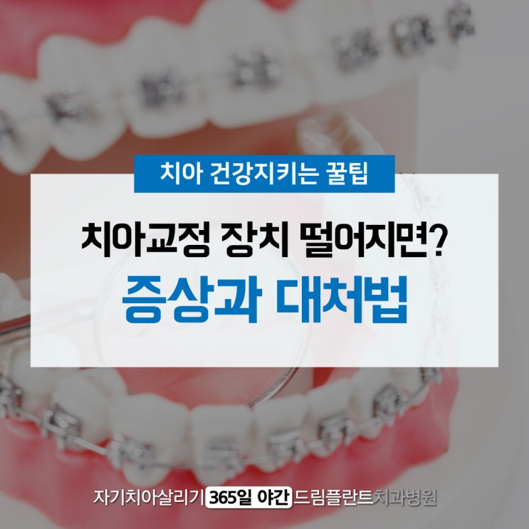 김해 일요일치과에서 알려드리는 치아교정 장치 떨어졌을 때 대처법 교정장치 탈락 방치하면 네이버 블로그