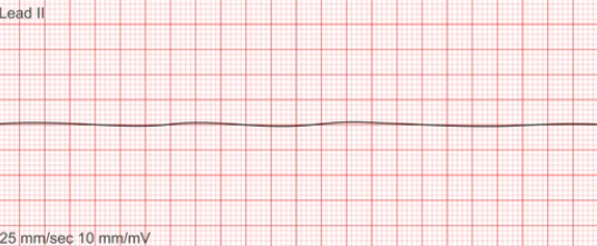 APLS (Advanced Pediatric Life Support) 소아 소생법 / Shockable and Non ...