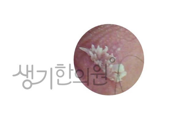 곤지름 성기에 발생한 사마귀 감염증 네이버 블로그