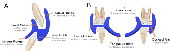 아이 교정치료에 사용하는 프리오쏘 preortho나 근기능 장치를 아시는지요? 웃는E치과교정과 : 네이버 블로그