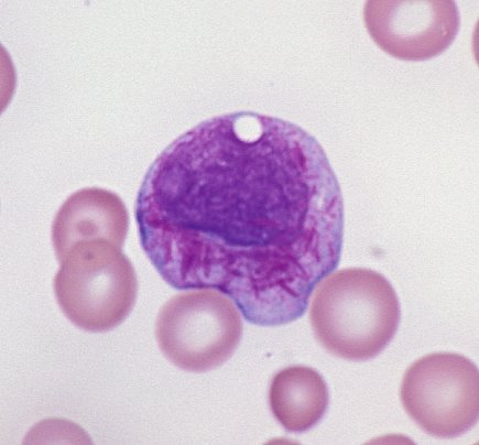 APL(Acute promyelocytic leukemia) : 급성 전골수성 백혈병 - 2021 NCCN : 네이버 블로그
