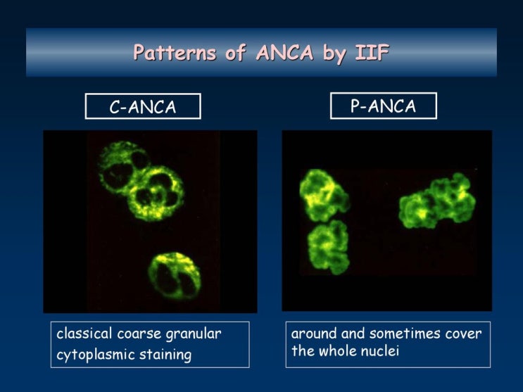 [강남류마티스/혈관염/대치동/역삼/논현]항호중구세포질항체 양성이라는데요 : 네이버 블로그