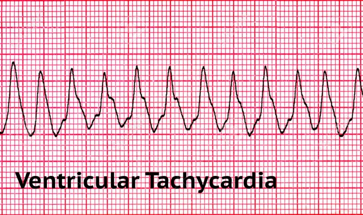 심실빈맥 , 심실세동 : 네이버 블로그