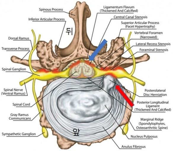 [경추]Series2-1경추 추간판 탈출증=목디스크란?(ft. 경추신경근병증) : 네이버 블로그