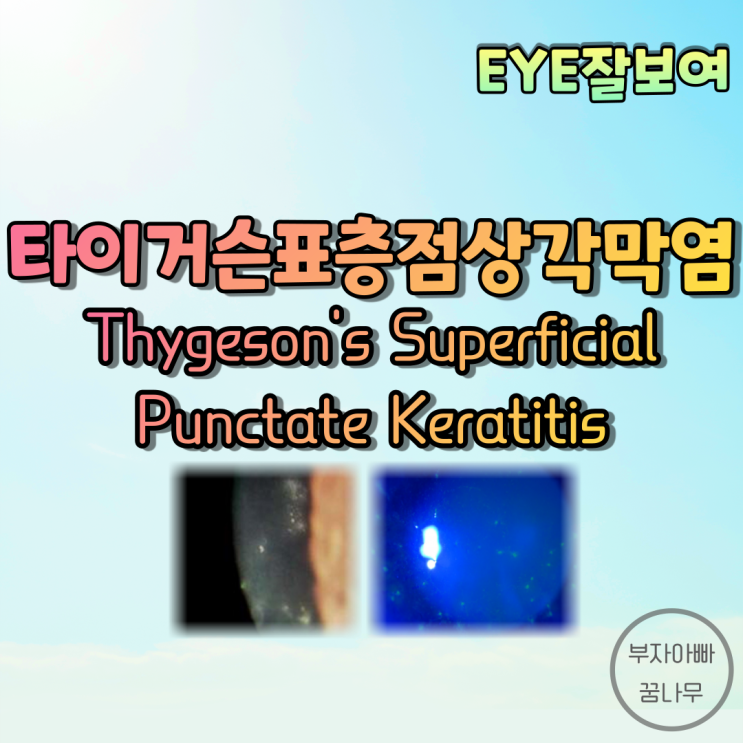 [EYE잘보여] 타이거슨 표층 점상 각막염(Thygeson's Superficial Punctate Keratitis; TSPK ...