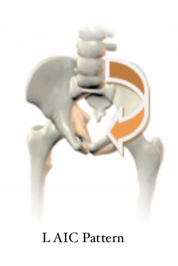 [필라테스 해부학] 골반틀어짐의 일반적인 패턴 - L AIC Pattern 이해하기 : 네이버 블로그