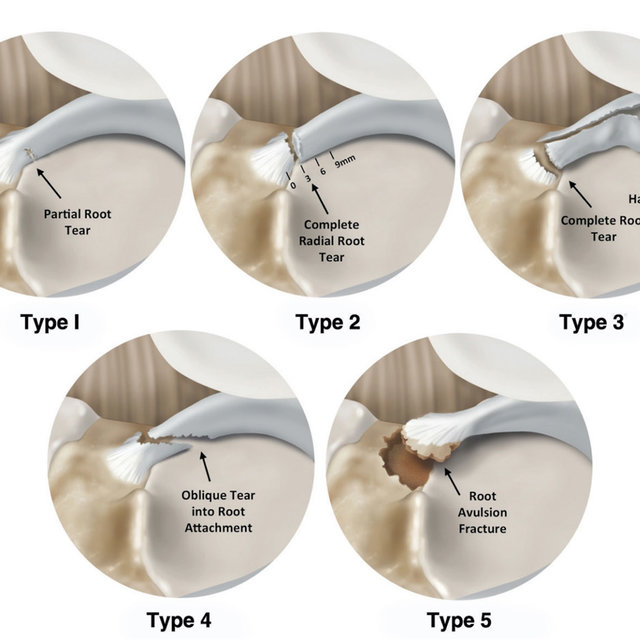 Knee A/S Root Repair (1) : 네이버 블로그