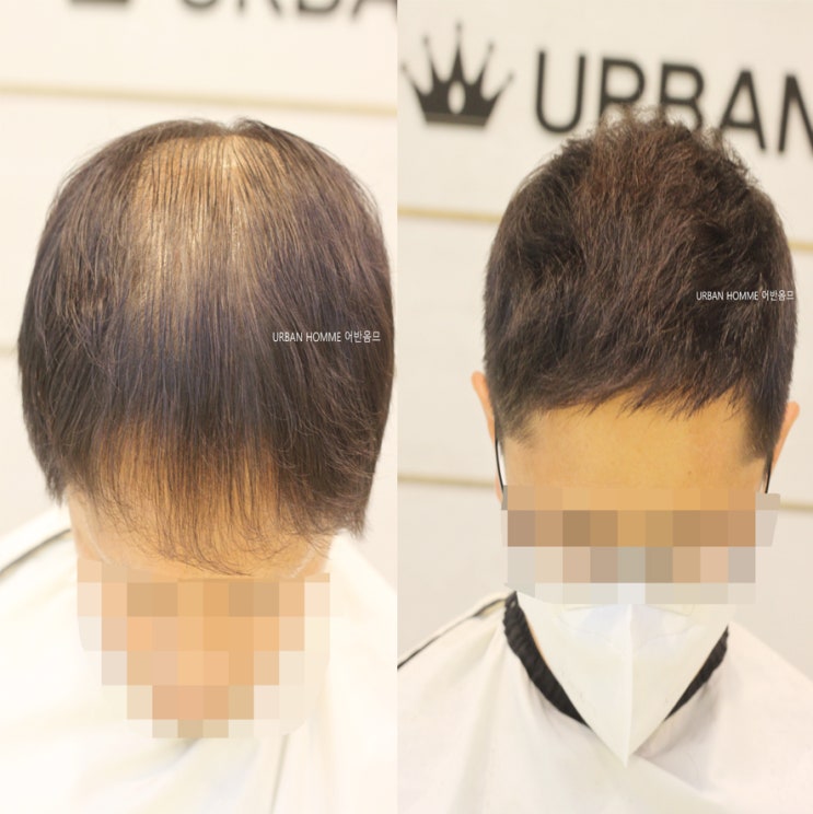 남자 탈모 펌 커버 전문 헤어디자이너 찾아가 또 했죠 네이버 블로그