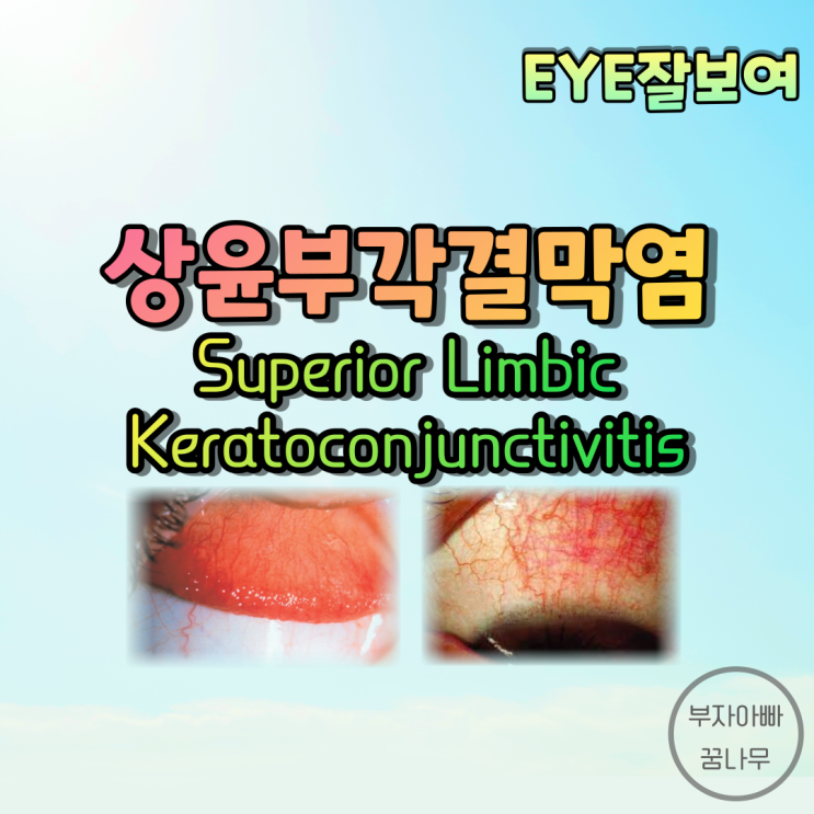 [EYE잘보여] 상윤부각결막염(Superior Limbic Keratoconjunctivitis; SLK) - 정의, 발병기전 ...