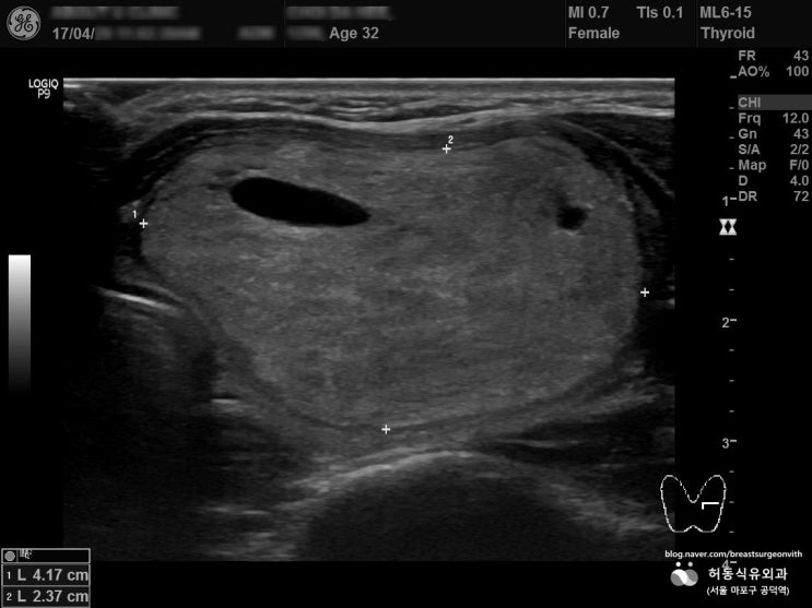 30대 갑상선 거대결절 고주파절제술열치료술후 3년 경과 허동식유외과 마포갑상선 공덕갑상선 네이버 블로그