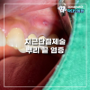 잇몸 혹 치근단농양 뿌리 치근단절제술 Apicoectomy 신경치료 Mta 치조골이식 네이버 블로그