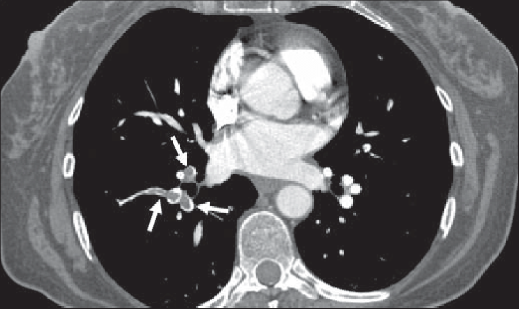 Pulmonary embolism(폐색전증, PE) : 네이버 블로그