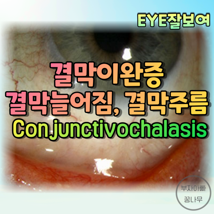 [EYE잘보여] 결막이완증(Conjunctivochalasis); 결막늘어짐, 결막주름, 늘어진 흰동자 - 원인, 증상, 진단 ...
