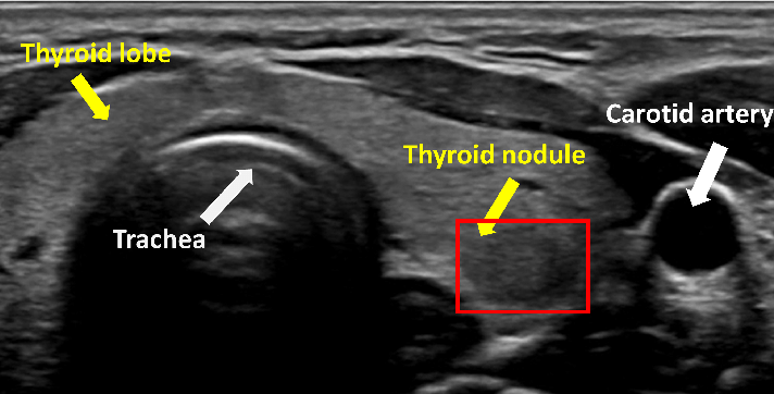 갑상선 초음파 (Thyroid Ultrasound) : 네이버 블로그
