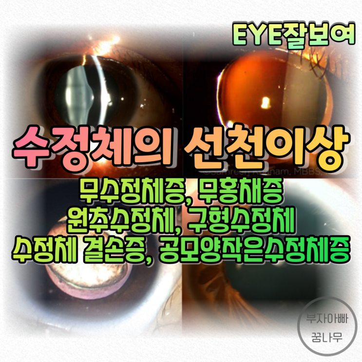 [EYE잘보여] 수정체의 선천이상 - 무수정체증, 원추수정체, 구형수정체, 수정체 결손증, 미텐도르프점, Epicapsular ...