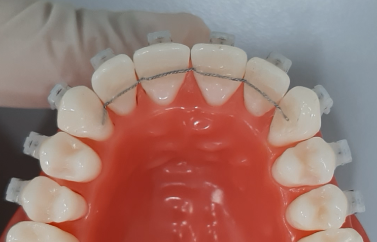 철사 유지 장치 칫솔질법 - How to brush fixed retainers (bonded retainers) 향남교정치과 ...