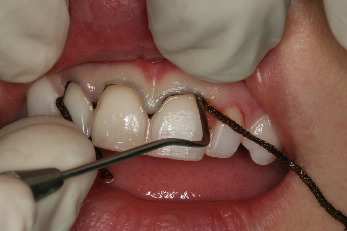 Cord packing & Bleeding control : 네이버 블로그