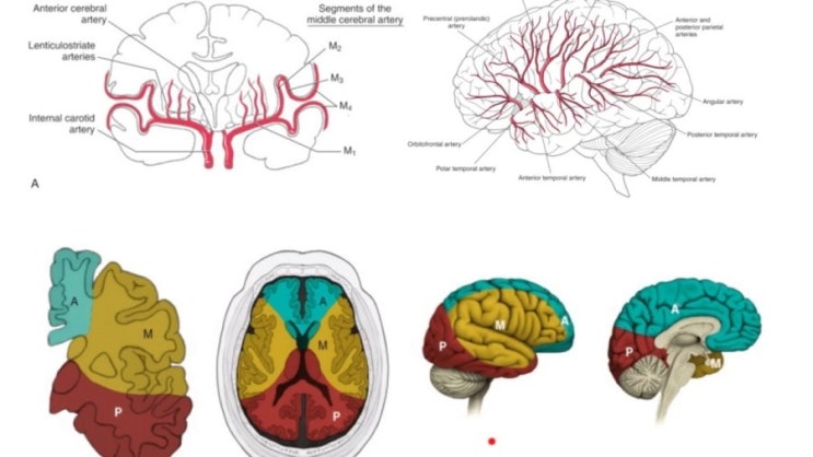 중대뇌동맥경색(MCA Infarction)의 증상들 : 네이버 블로그
