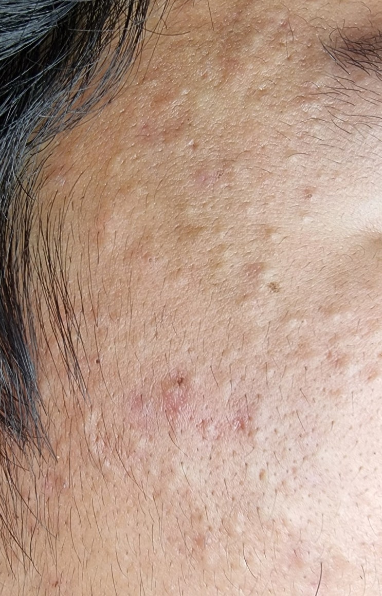 테스토스테론(Testosterone)과 여드름(acne) : 네이버 블로그