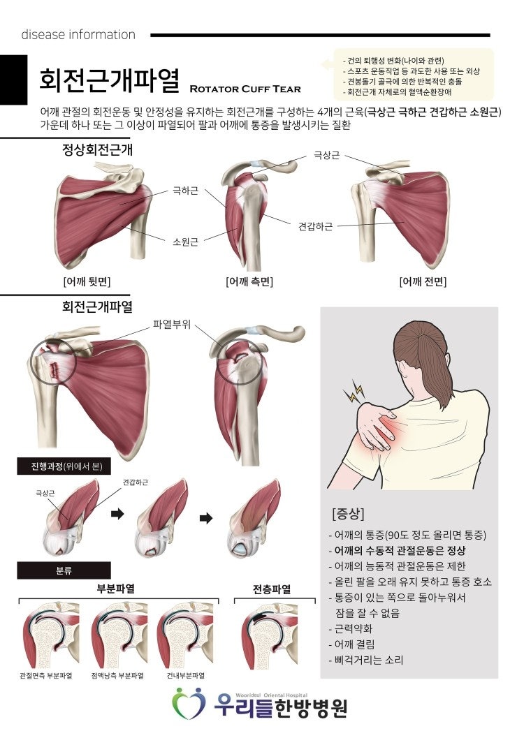 순천 회전근개 파열 회전근개증후군 옷 입고 벗을 때 팔을 올릴 때 어깨 통증을 유발하는 회전근개 파열에 대하여