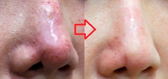 필러 괴사 흉터 이식 흉터 치료 사례 피부과 전문의 흉터 제거술 Dna 진피 재생술 핀홀법 네이버 블로그
