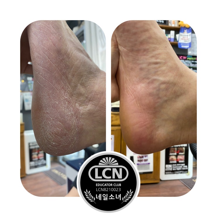 청주네일 가경동네일샵 네일소녀 겨울철발각질관리하기 네이버 블로그