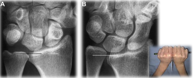 삼각섬유연골복합체(TFCC) 손상에 대해 알아봅시다 (4) - 진단-2(방사선검사) : 네이버 블로그