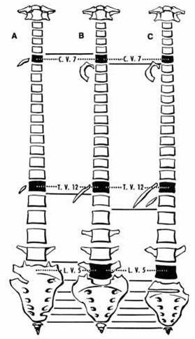 [요추] lumbosacral transitional vertebrae, Sacralization, Lumbarization ...