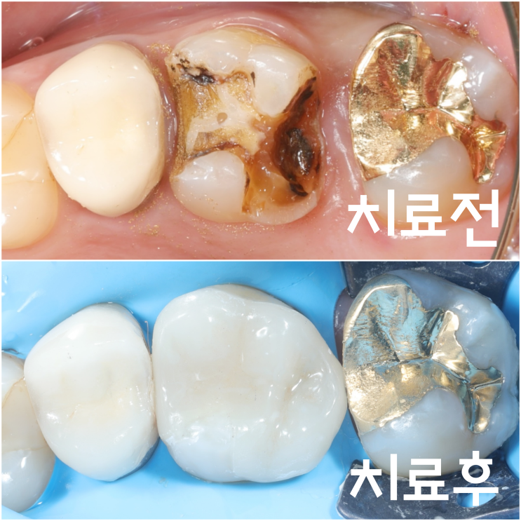 신경치료 및 크라운 하지 않고 온레이 이맥스로 마무리하기부제치아를 보존하는 치료는 어렵다 네이버 블로그