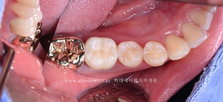 치아 뿌리 끝 염증 재신경치료와 지르코니아 크라운으로 치료해 드린 증례 네이버 블로그
