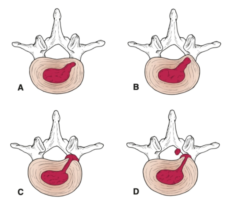 Pathology of the intervertebral disc : 네이버 블로그