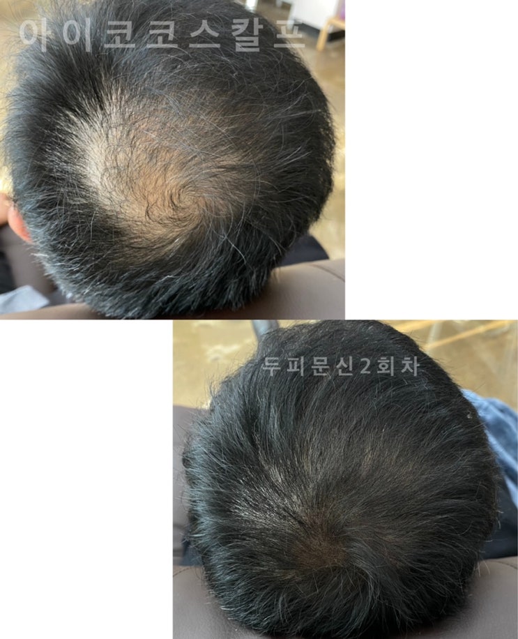 대전 남자 정수리 탈모두피채움 2회차 네이버 블로그