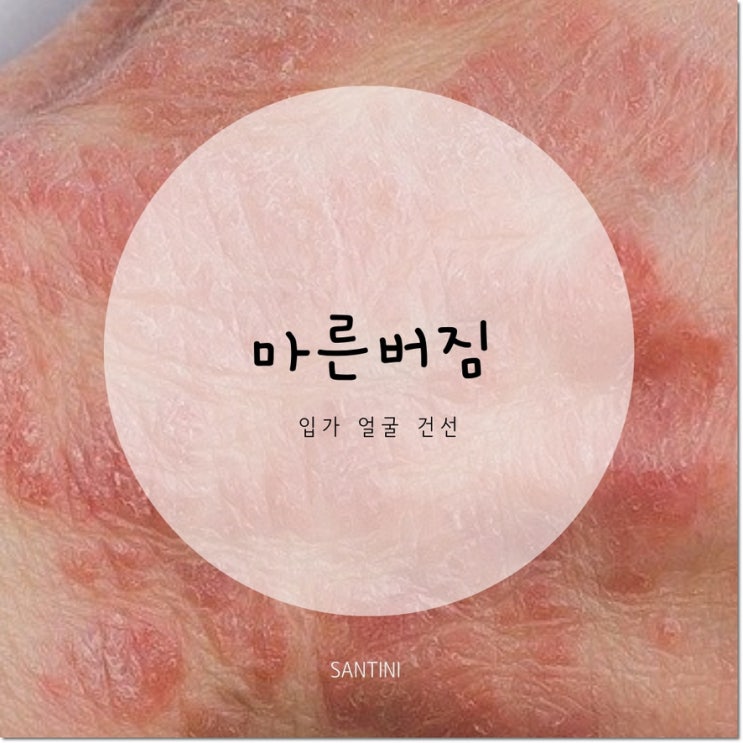 얼굴 입가 피부 마른버짐 원인 과 관리 네이버 블로그