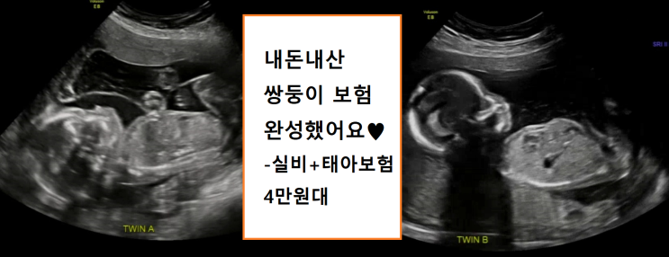 내돈내산 셀프태아보험가입 이란성 쌍둥이 태아보험 시험관 Ok 초기출혈 Ok 신장이식환자 Ok 혼자 공부하고