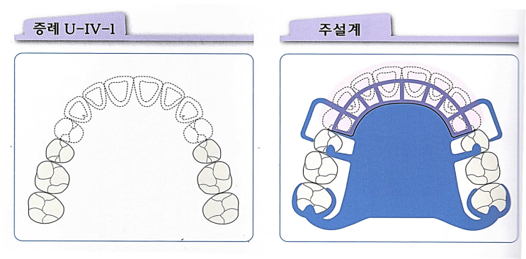 [백은준 수석원장님 칼럼] Kennedy Class IV 치아지지 국소의치 디자인 : 네이버 블로그
