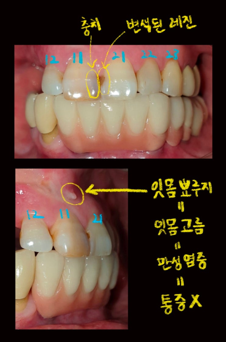 앞니충치 잇몸 뾰루지잇몸고름 원인은 충치로 인한 신경괴사 Ft앞니레진 재치료 네이버 블로그