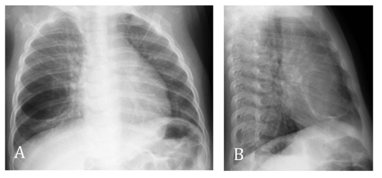 Congenital pulmonary airway malformation (CPAM) : 네이버 블로그