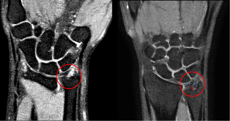 삼각섬유연골복합체(TFCC) 손상에 대해 알아봅시다 (5) - 진단-3(MRI 및 관절경) : 네이버 블로그