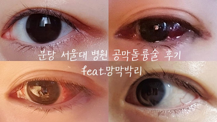 분당서울대학교병원 공막돌륭술 후기망막박리 응급수술 네이버 블로그