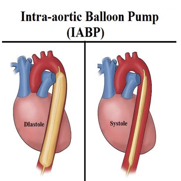 IABP : 네이버 블로그