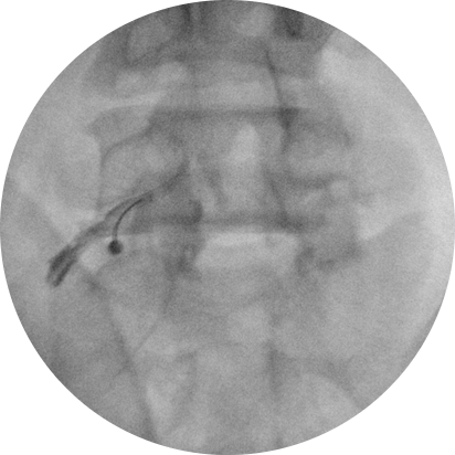 Lumbar selective nerve root block (SNRB) : 네이버 블로그