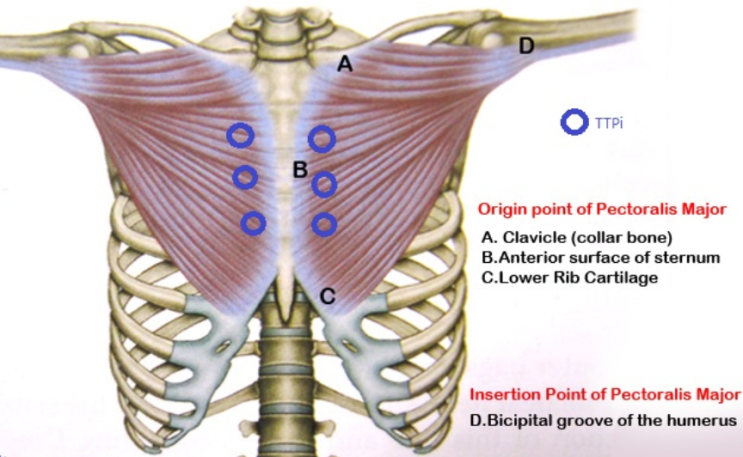 [흉골]★명치, 가슴앞 흉골 통증 Sternum / Xiphisternal joint : Tietze syndrome ...