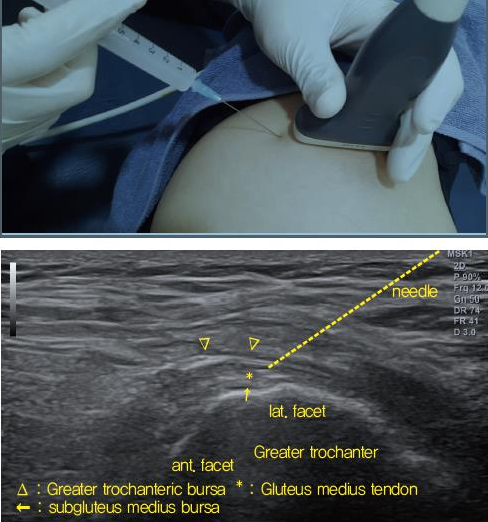 [고관절] 대전자 동통 증후근 greater trochanteric pain syndrome (GTPS) : 네이버 블로그